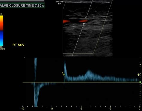 Toe Brachial Index