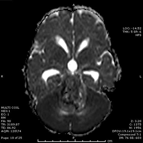 pediatric tumors detection instance segmentation dataset by blue
