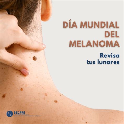 📆 Día Mundial Contra El Melanoma ⁣ Secpre