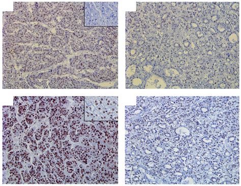 Expression Of Gli 1 And Gli 2 Nuclear Staining Of Gli 1 In A A Download Scientific Diagram