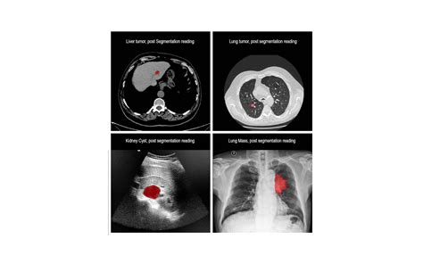 Rsip Vision Announces Versatile Medical Image Segmentation Tool Axis