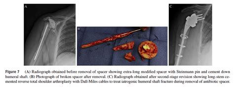 UW Shoulder And Elbow Academy Are Antibiotic Spacers A Benign Treatment For Shoulder Infections