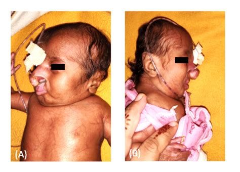 In The Shadows Of Rarity A Case Report Of Syndromic Cleft Lip And