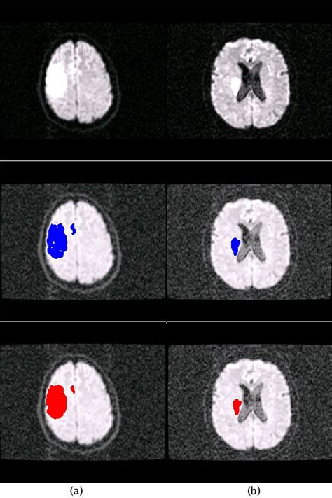 An Example Of The Automatic Segmentation In Two Patients An Axial Download Scientific Diagram