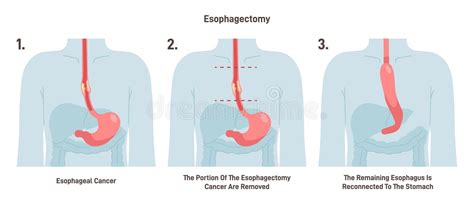 Excision Stock Illustrations 308 Excision Stock Illustrations