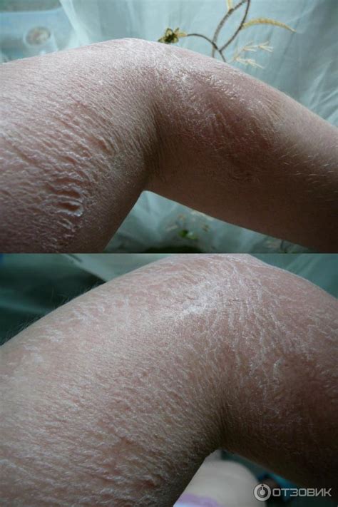 Отзыв о Гель Фармамед Димексид 25 НЕ ПОКУПАЙТЕ ПОЛНАЯ ЕРУНДА