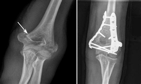 Elbow Fractures Distal Humerus Journal Of Hand Surgery Vro