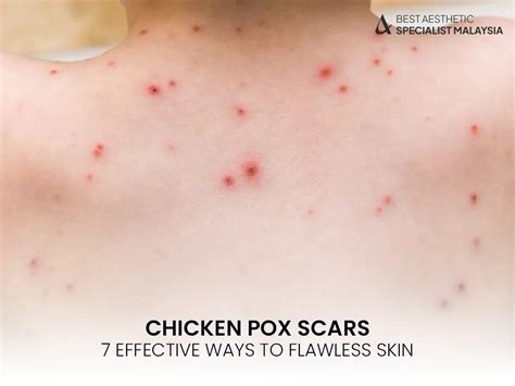 Chicken Pox Scars 7 Effective Ways To Treat For Skin