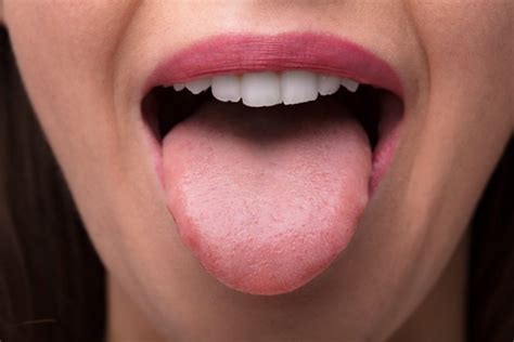 Hpv Bumps On Your Tongue Hpv Hub Llc