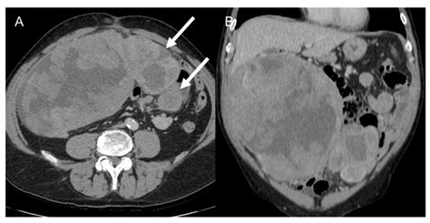 Ct And Mr Imaging Of Retroperitoneal Sarcomas A Practical Guide For