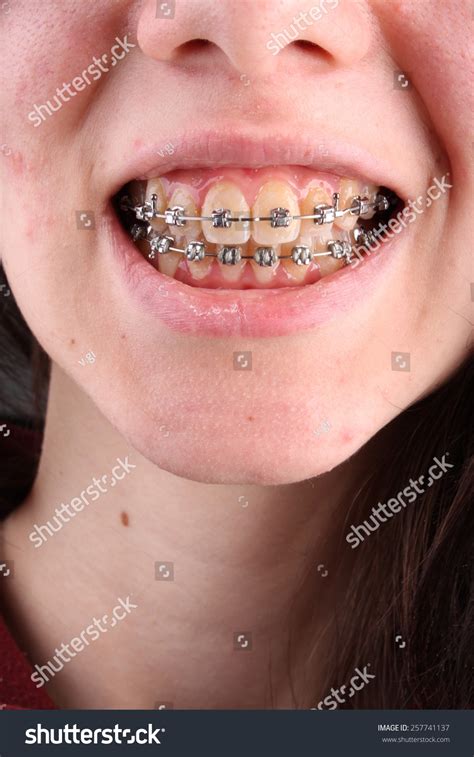 Unhealthy Teeth With Braces