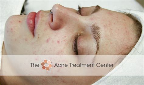Beforeafter Patient Photos Hyperpigmentation Inflamed Acne The