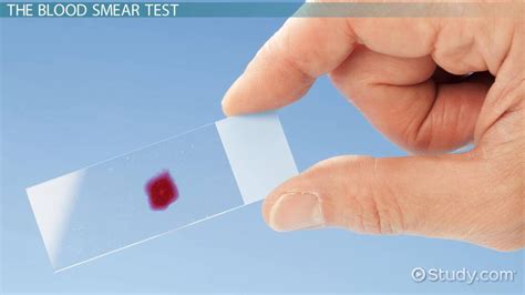 Thick Blood Smear And Thin Blood Smear 57 OFF