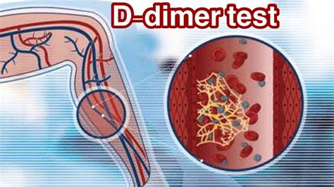 D Dimer Test What Does A High D Dimer Mean What Is D Dimer Normal Range Youtube