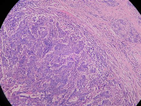 Medullary Carcinoma Breast Histopathologyguru