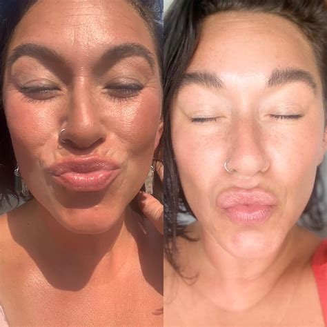 😍😍😍😍😍 Before And After Express Med Spa Frankfort