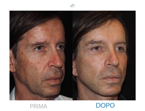 Caso FaceLift 07ott20 Obl Dr Michele Pascali