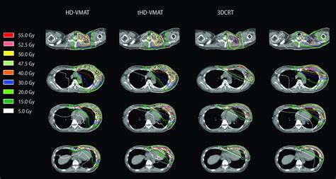 Dose Distributions Of Volumetric Modulated Arc Radiotherapy Using Download Scientific Diagram