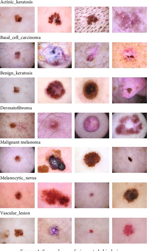 Figure 1 From Multiscale Feature Fusion For Skin Lesion Classification Semantic Scholar