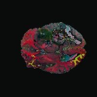 Brain Tumor Detection Object Detection Dataset And Pre Trained Model By Yousef Ghanem