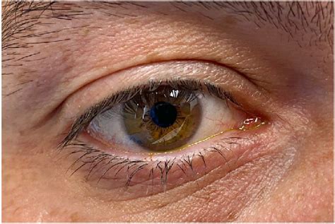 Right Eye One Week Post Initial Review Resolution Of Download Scientific Diagram