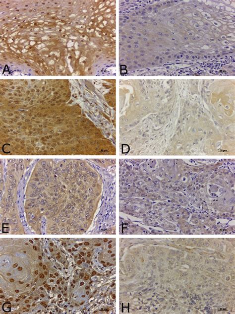 Imunnohistochemistry Photomicrographs A Strong Intensity Cytoplasmic