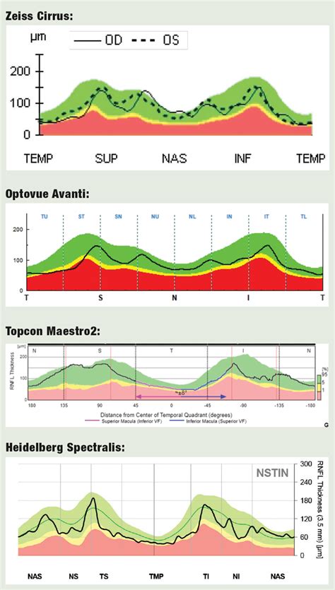 How Do Oct Devices For Glaucoma Compare