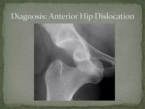 Anterior Hip Dislocation Pptx