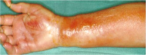 Infections Of Deep Hand And Wrist Compartments