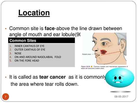 Rodent Ulcer