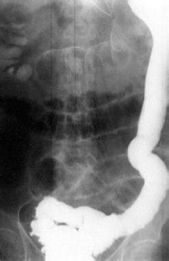 Large Bowel Obstruction Practice Essentials Background Pathophysiology