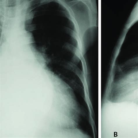 Felsons Classification Of Mediastinum In Anterior Middle And