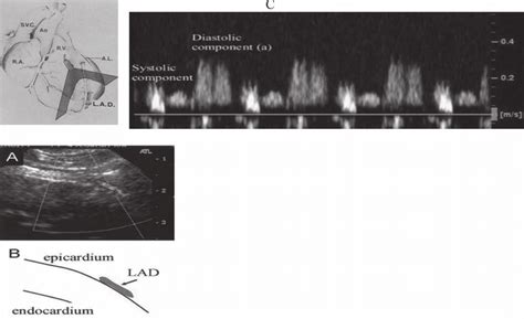 A And B Distal Lad Flow Visualized By Colour Ttde C Phasic Distal