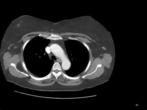 Radiotherapy Target Delineation In Breast Cancer Pptx