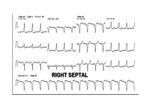 Localization Of Wpw Accessory Pathway By Surface Ecg Pptx