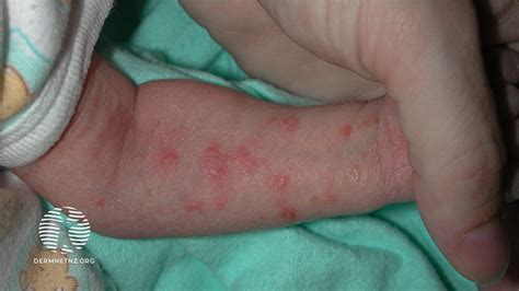 Case 7 Day Old With A Pustular And Vesicular Rash