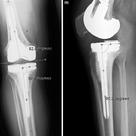 A Coronal Alignment Of The Tibial And Femoral Components According To