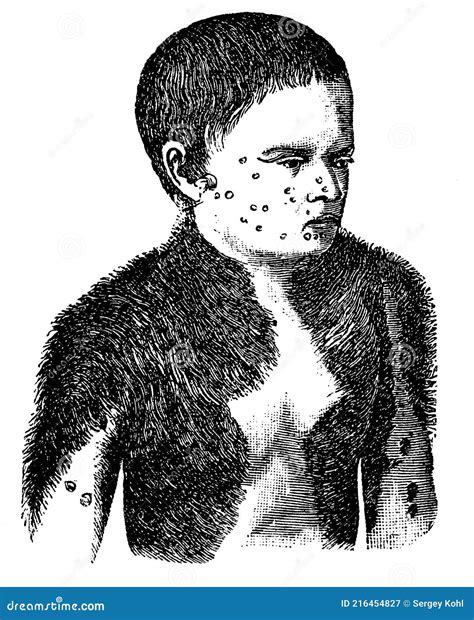 Hypertrichosis Cartoons Illustrations And Vector Stock Images 123