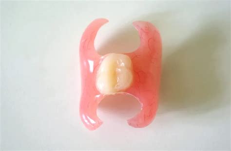 Single Tooth Removable Partial Denture