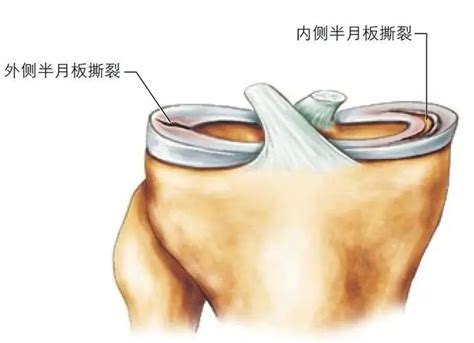 膝关节扭伤如何初步评估 健康160