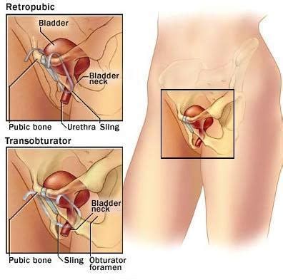 Vaginal Mesh Complications Urology Associates