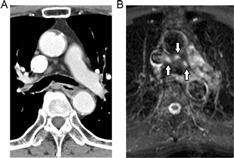 Three Regional Metastases In The Lower Paratracheal Lymph Nodes