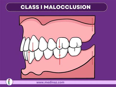 Angles Classification Malocclusion Dental Notes