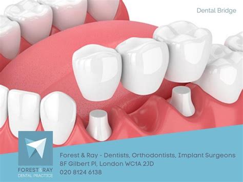 Understanding Root Canal Infections Causes Symptoms And Treatments