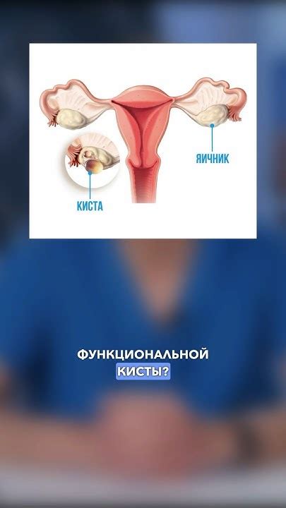 Ни в коем случае не делайте это если у вас киста яичника гинекология Youtube