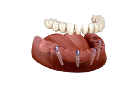 Trồng Implant Vài Răng Nha Khoa Ken