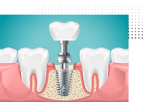 Tooth Replacement Dental Prosthetics Vanilla Smile Dental Clinic