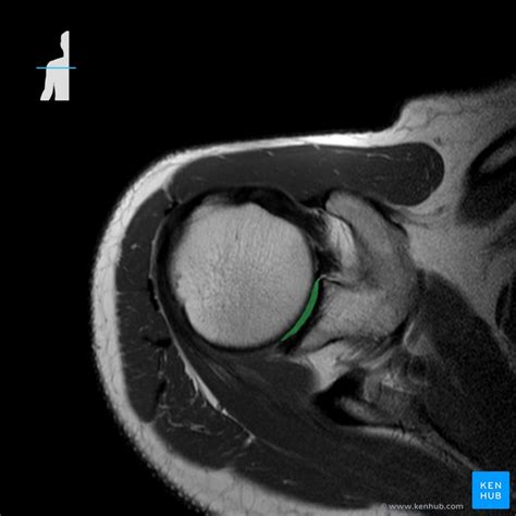 Normal Shoulder Mri How To Read A Shoulder Mri Kenhub