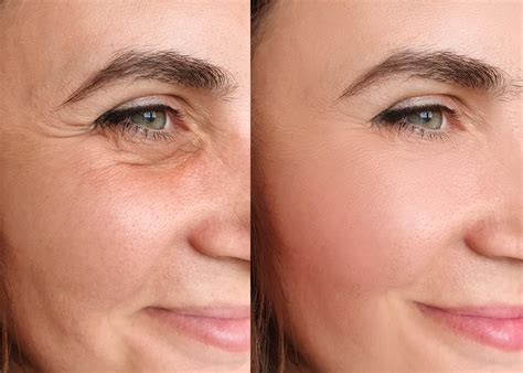 How To Reduce And Prevent Crows Feet Face Clinic London