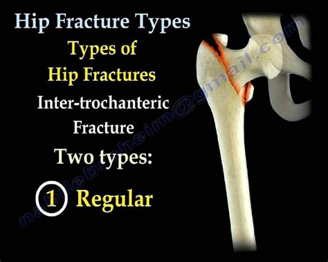 Hip Fractures Types And Fixation Everything You Need To Know Dr N Hip Fracture